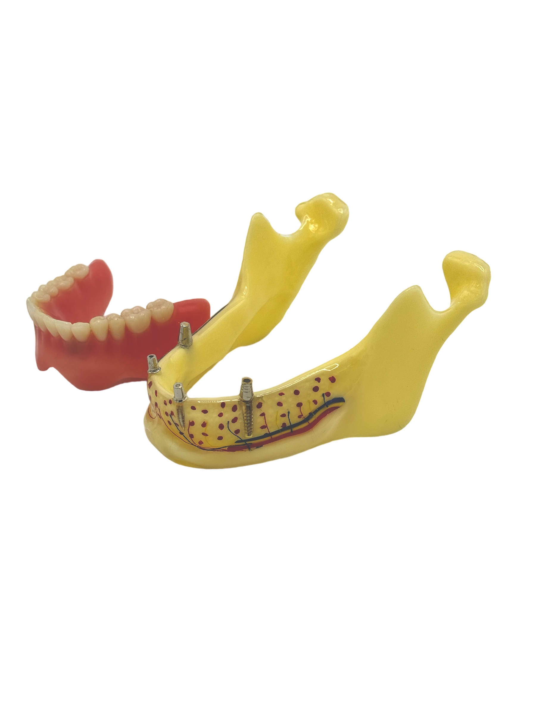 Modèle d'étude de la mâchoire inférieure avec 4 implants de forme ...